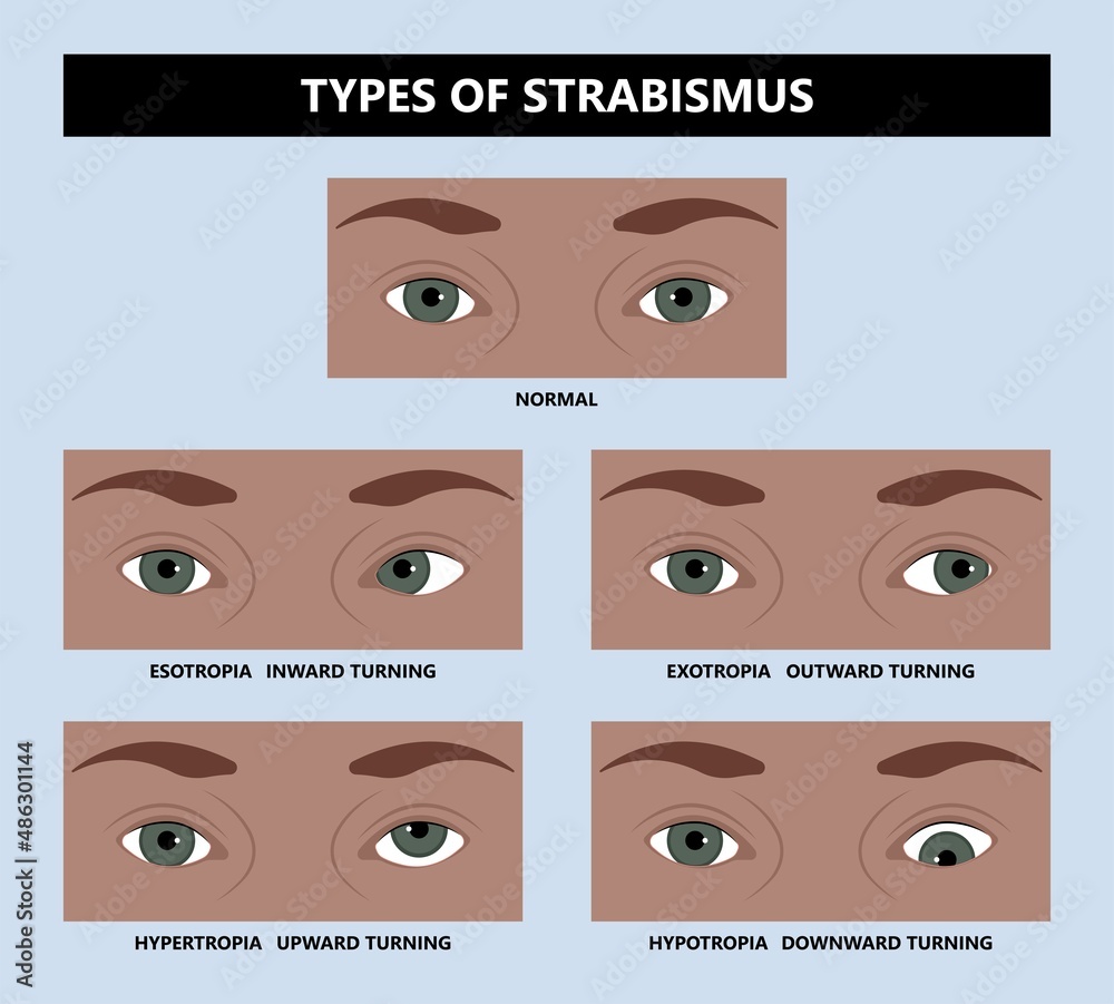 Diplopia double vision test exam brain nerve dry eye palsy gravis ...