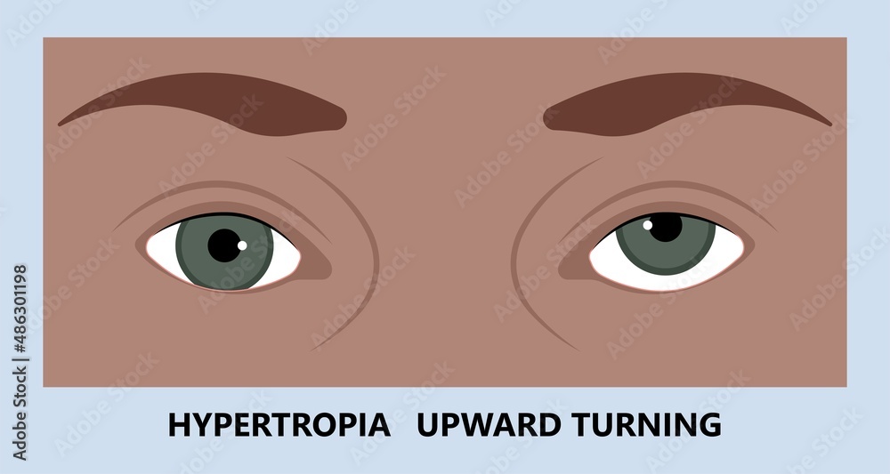 Vector de Stock Diplopia double vision test exam brain nerve dry eye ...