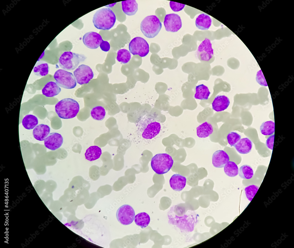 ภาพถ่าย Stock Blood Cancer, Leukemia Awareness. Photomicrograph of bone ...
