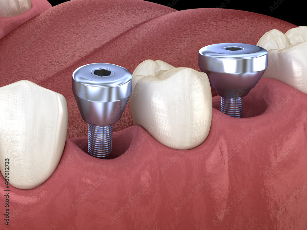 Cover screw - temporary implant abutment. Medically accurate 3D ...