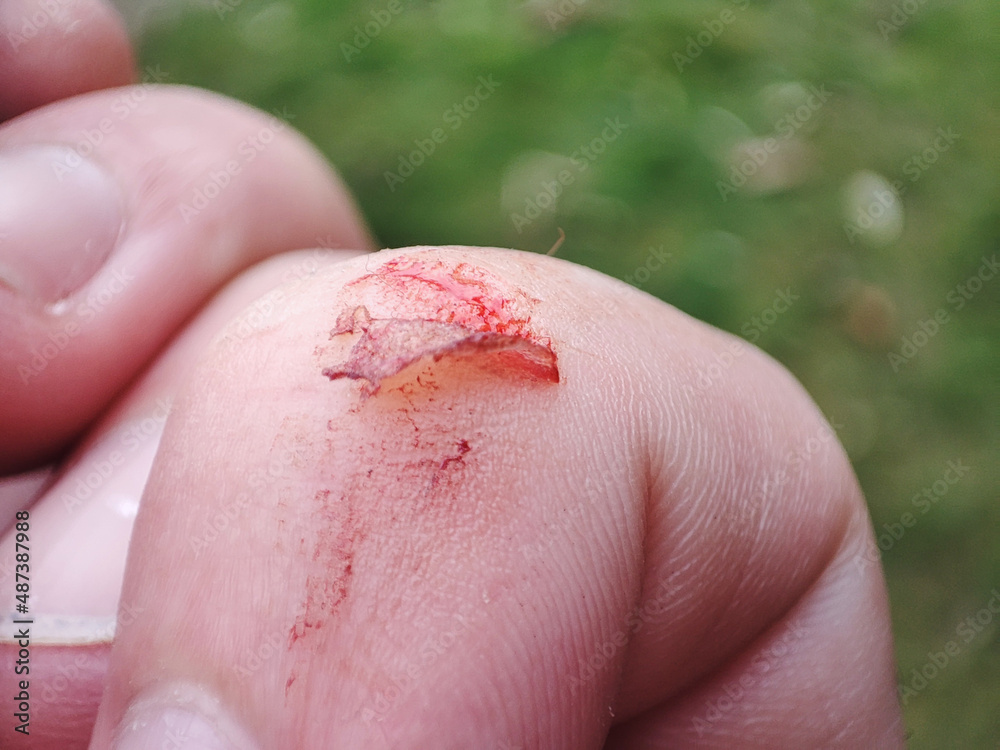 Injured finger with bleeding open cut. Deep wound. the injured finger ...