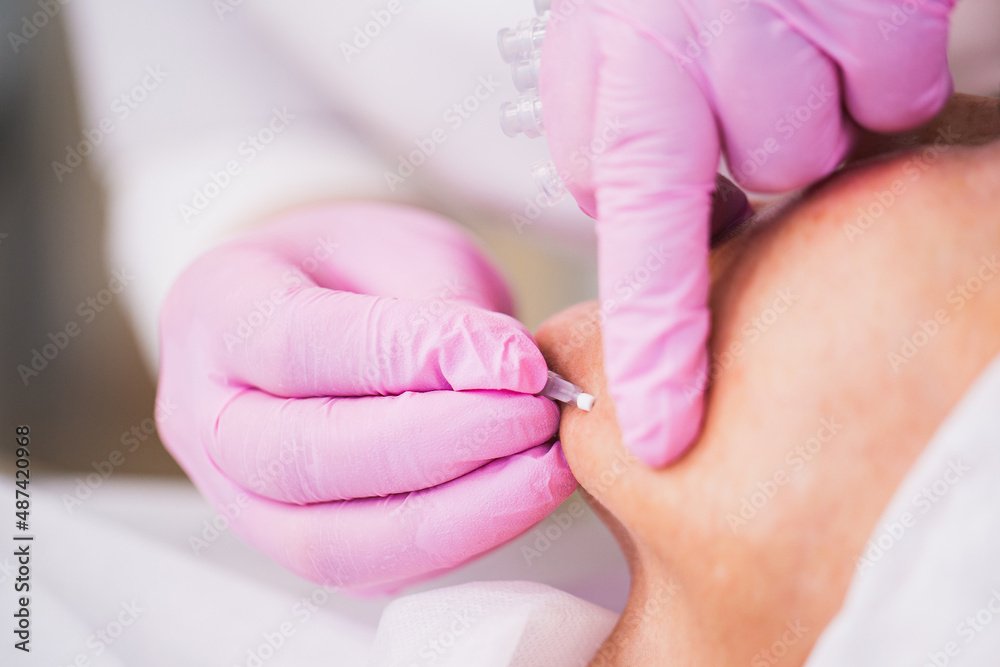 Thread lifting is a minimally invasive procedure for tightening the ...