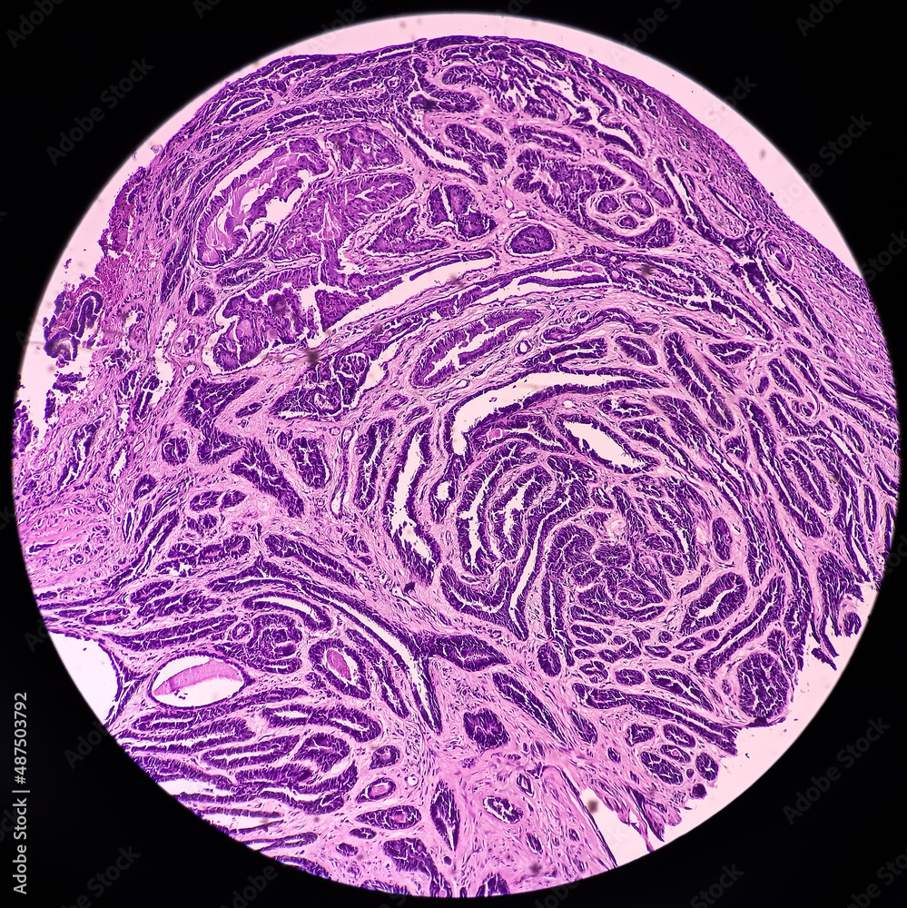 Hidradenoma papilliferum: Benign skin tumor, rare benign neoplasm ...