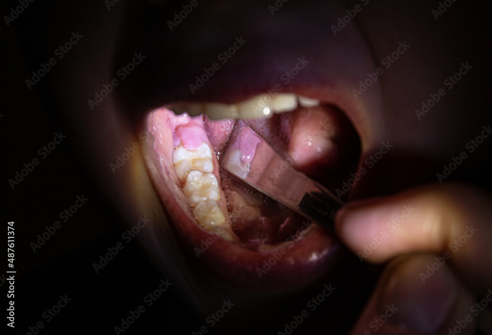Stock-Foto „6 year old child with gum flap over child molar. Medical ...