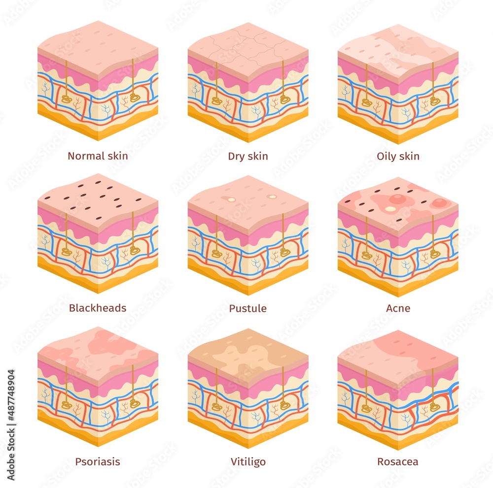 3d human skin types cross section layers. Dry, oily and normal ...