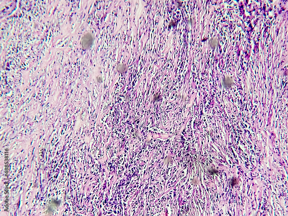 Tissue form Gallbladder (Laparoscopic cholecysectomy) hematoxylin and ...