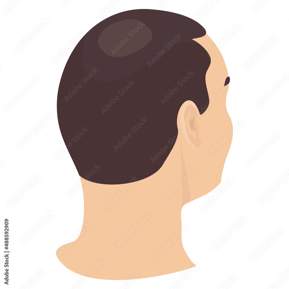Head of a man with hair loss in side view. Different stages of alopecia ...