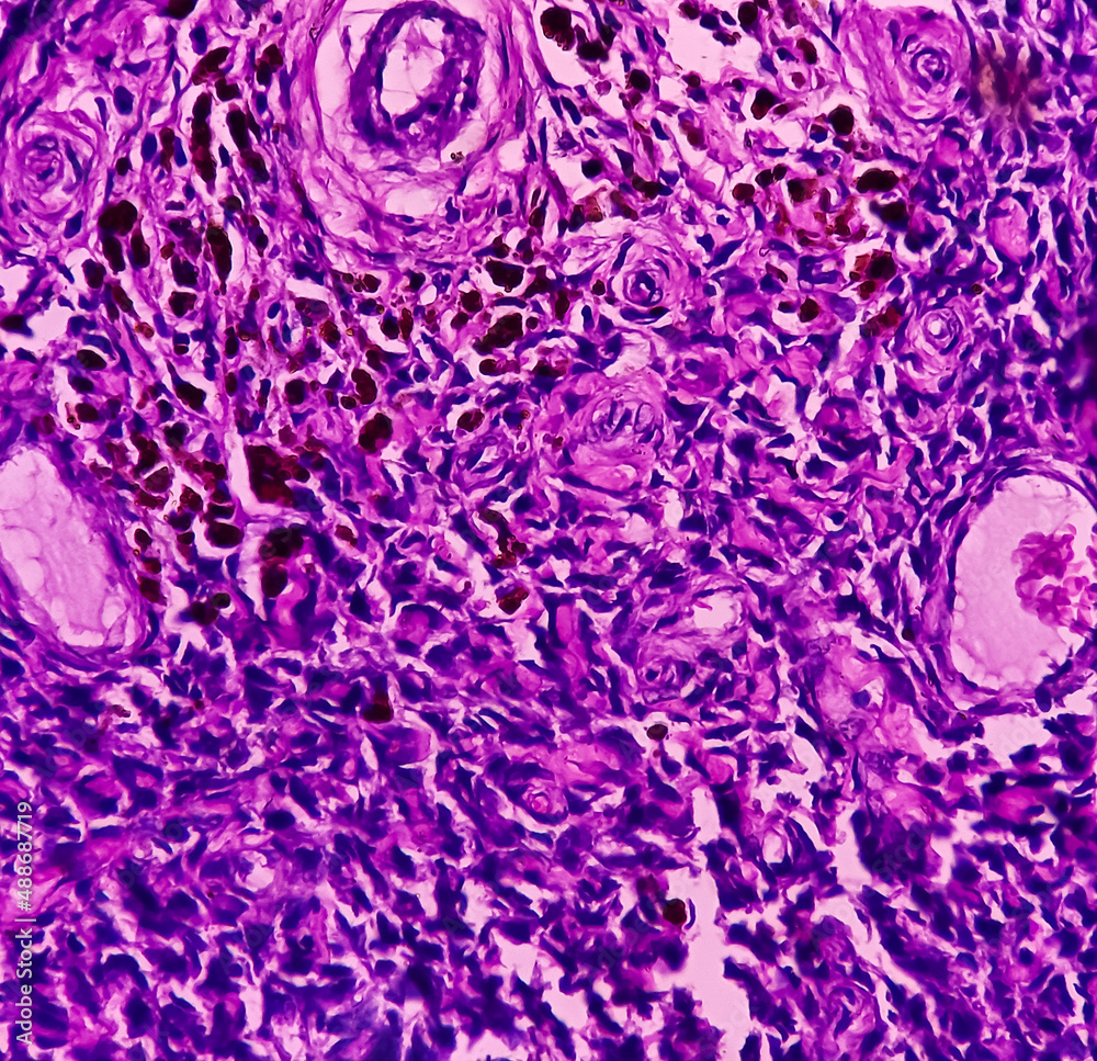 Scapula cancer: Synovial sarcoma, monophasic, show malignant neoplasm ...