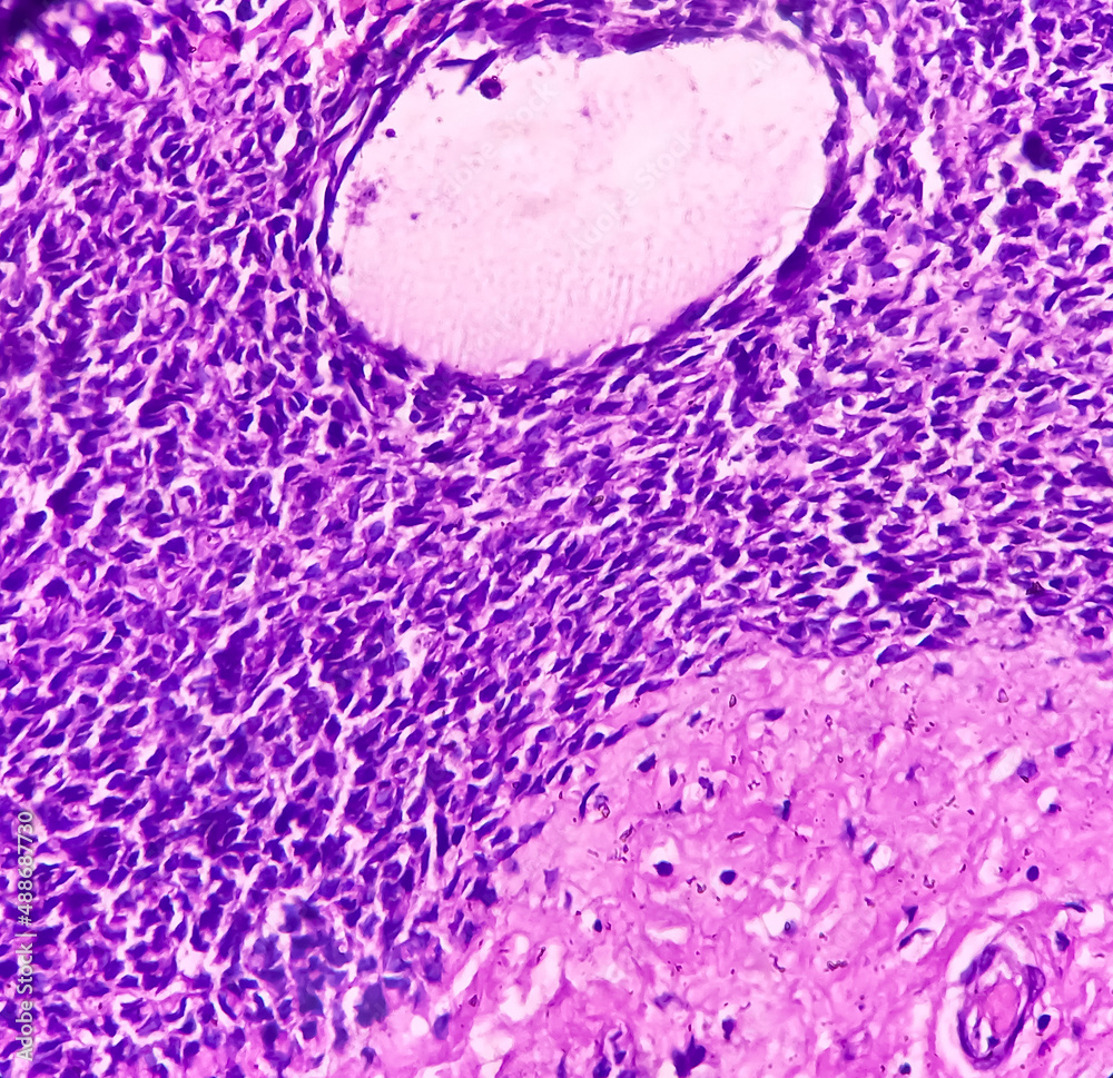 Scapula cancer: Synovial sarcoma, monophasic, show malignant neoplasm ...
