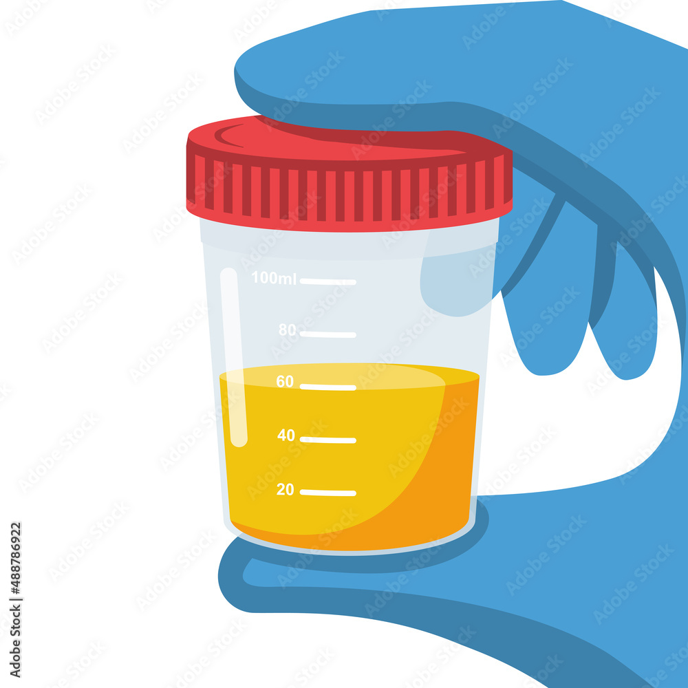 Urine analysis. The doctor in gloves holds jar with urine analysis ...