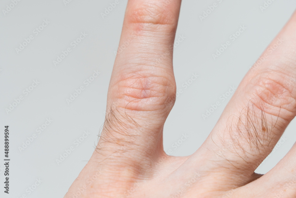 A protruding bone on the finger of the hand. Incorrect bone fusion ...