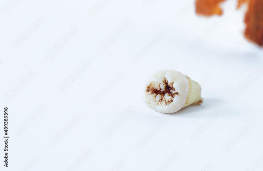 Extracted human wisdom tooth (molar) isolated on white background with ...