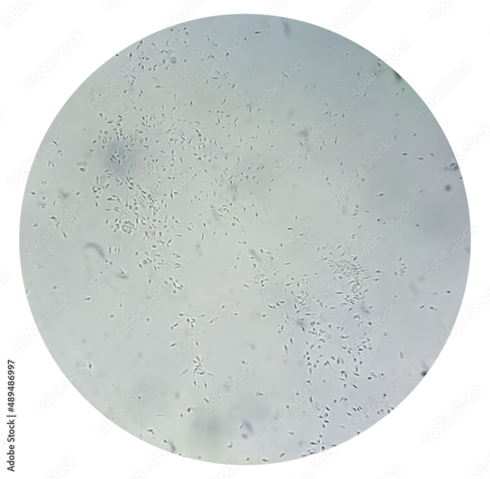 Semen analysis, sperm analysis on microscopic examination Stock Photo ...