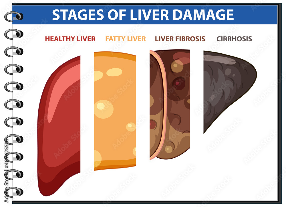 Diagram showing stages of liver damage Stock Vector | Adobe Stock