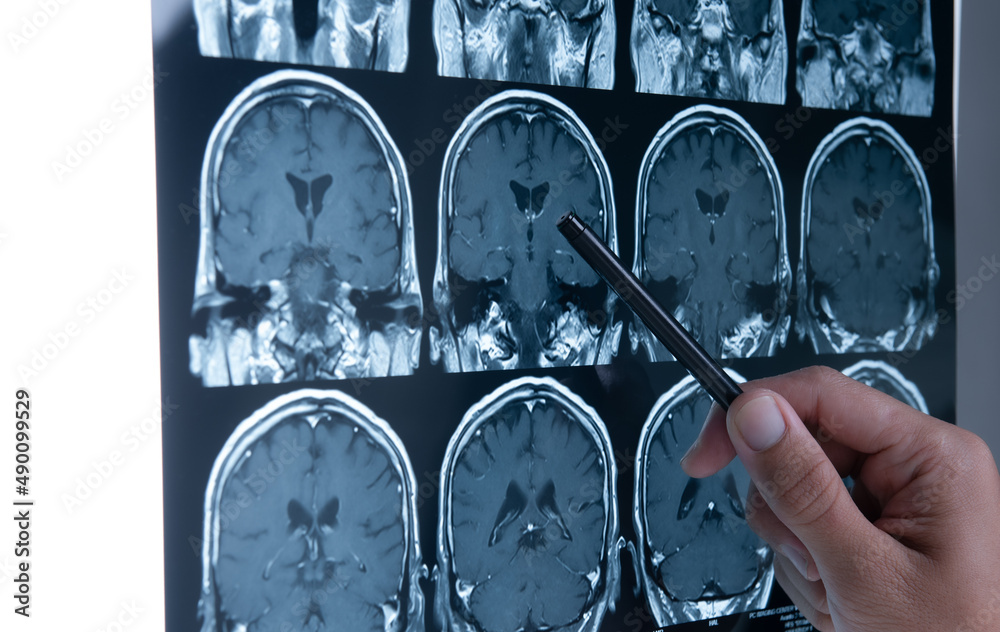 Doctors reviewing brain x-rays;MRI of the blood vessels in the brain ...