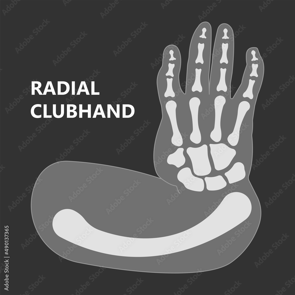 Hand finger gene prader willi band autism surgery baby simple thumb ...