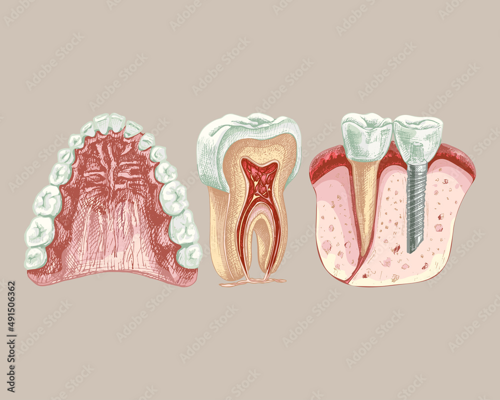 113_ jaw, teeth, gums, palate_dental implant_tooth structure, graphics ...