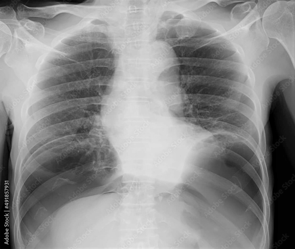 Chest x ray image of pneumoperitoneum ,free air on abdomen as luscent ...