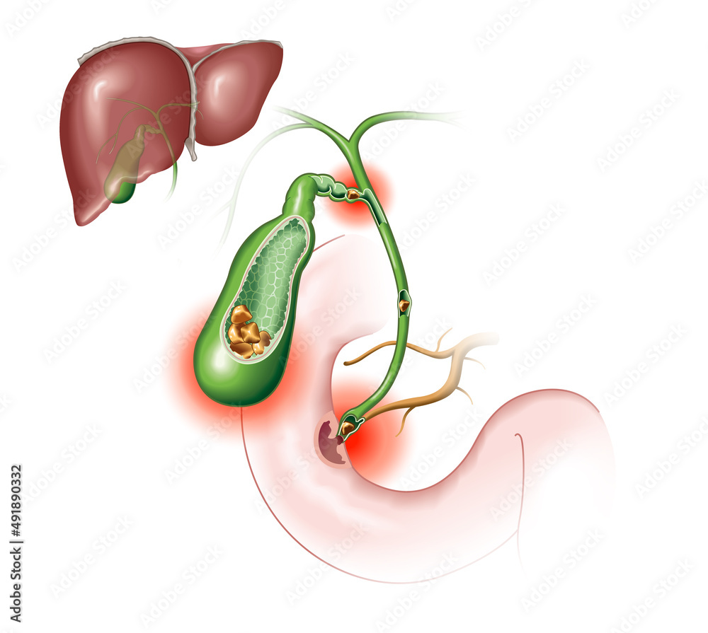 Gallstone disease. gallstones blocking bile duct and pancreatic duct ...