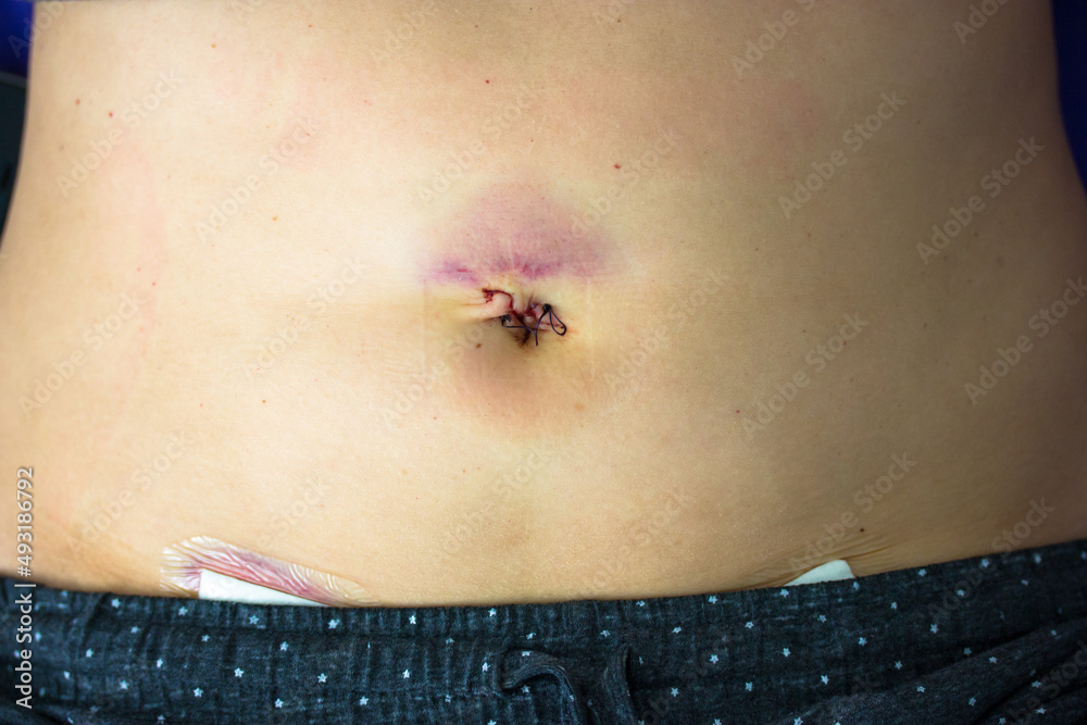 Foto de Stock Woman's abdomen fresh medical scars after laparoscopy ...