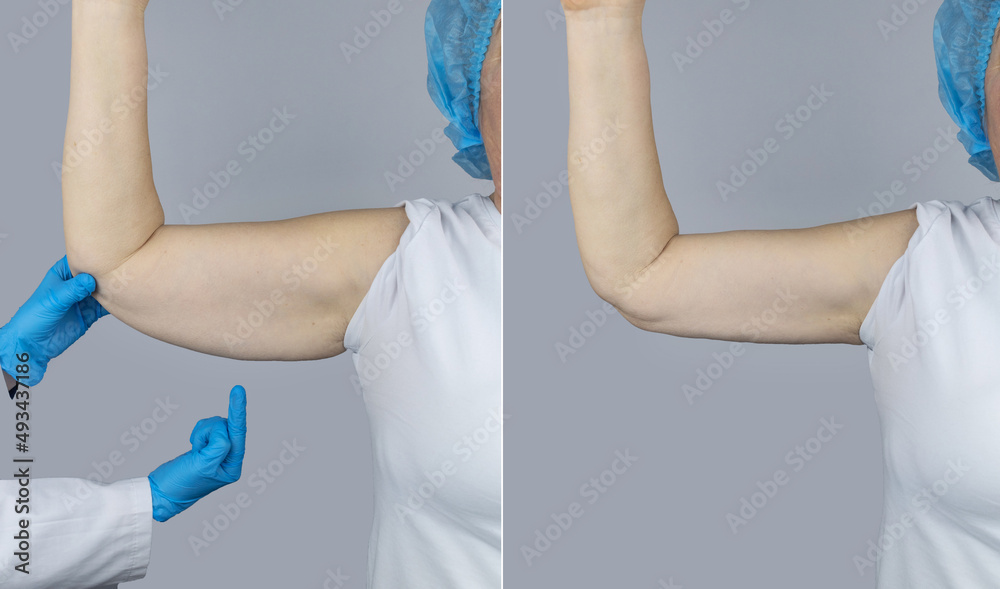 Before and after. Brachioplasty. Plastic arms, dangling skin at the ...