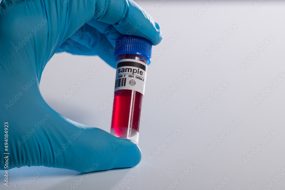 hand in medical gloves is presenting a blood probe in a tube with a ...