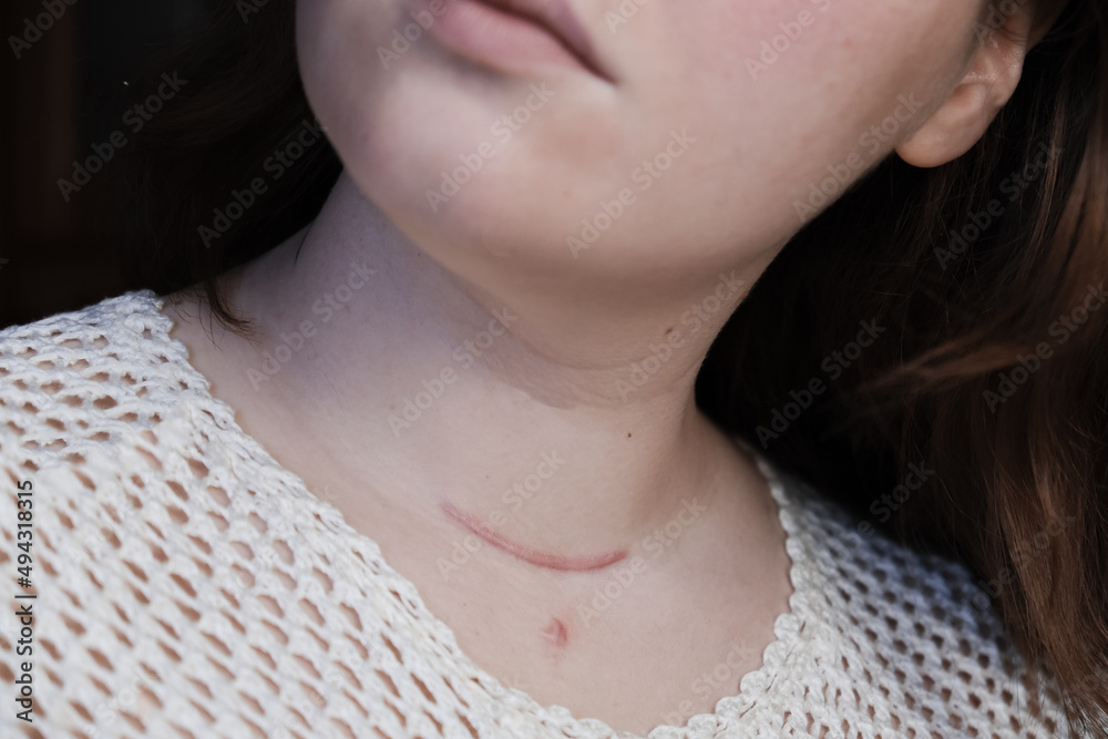 Scar on the neck. surgical wounds, removal of tumor and thyroid cancer ...