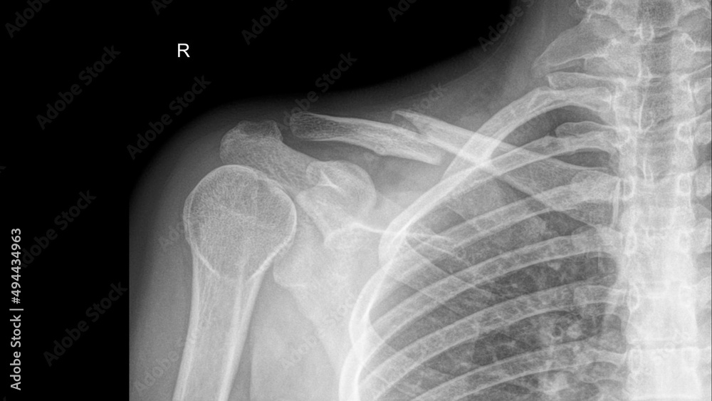 X-ray of a right clavicle fracture Stock Photo | Adobe Stock