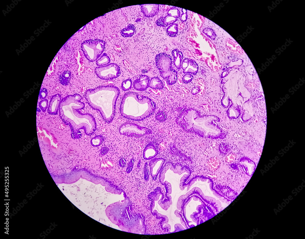 Close microscopic view of stomach tissue biopsy showing Adenomatous ...
