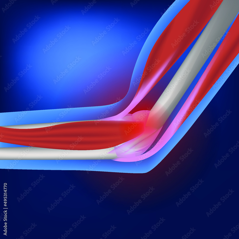 Stock-Vektorgrafik „Epicondylitis of the elbow joint. inflammatory and ...