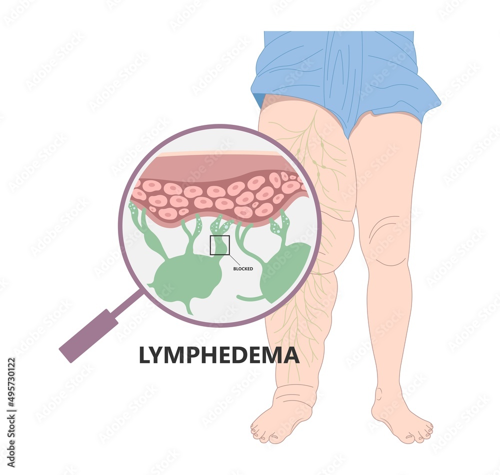 Leg edema venous syndrome Milroy Deep vein cancer swelling upper limb ...