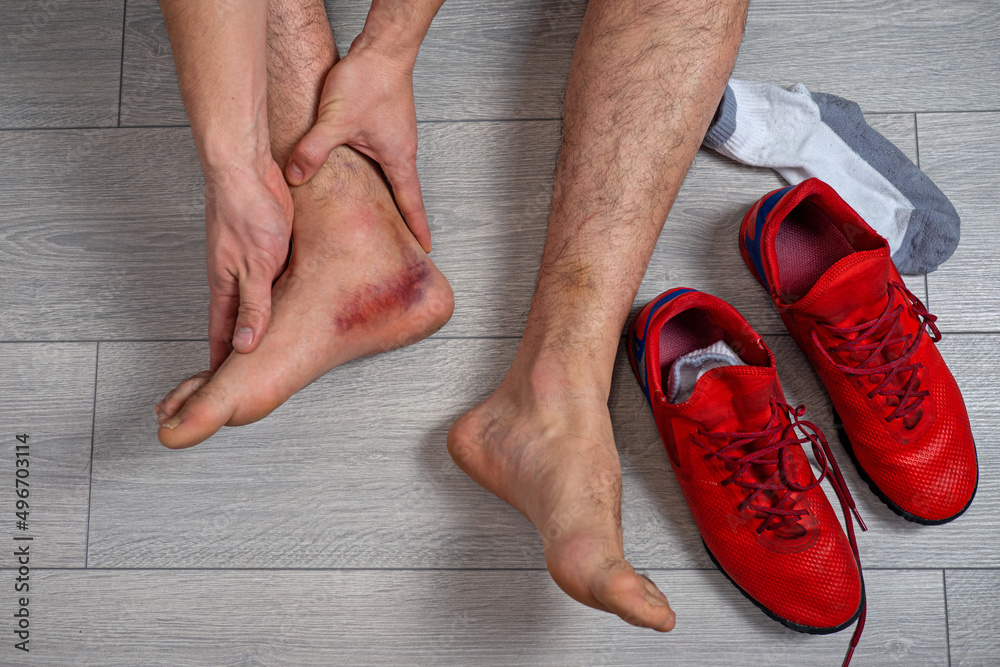 Ankle injury with dislocation and sprains. Fracture or Leg sprain ...