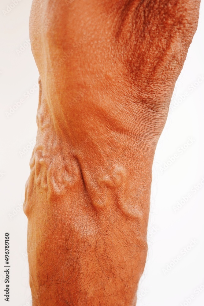 The severity of the varicose veins ranges from the tiny capillaries ...