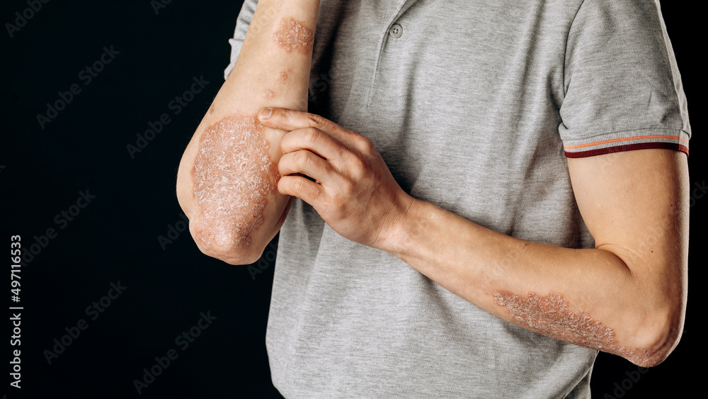 Acute psoriasis on the elbows is an autoimmune incurable dermatological ...