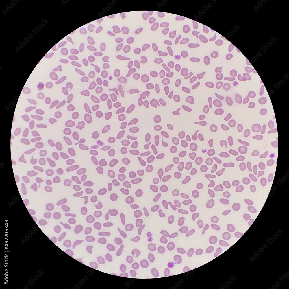 Elliptocytes (ovalocytes) are abnormally shaped red blood cells that ...