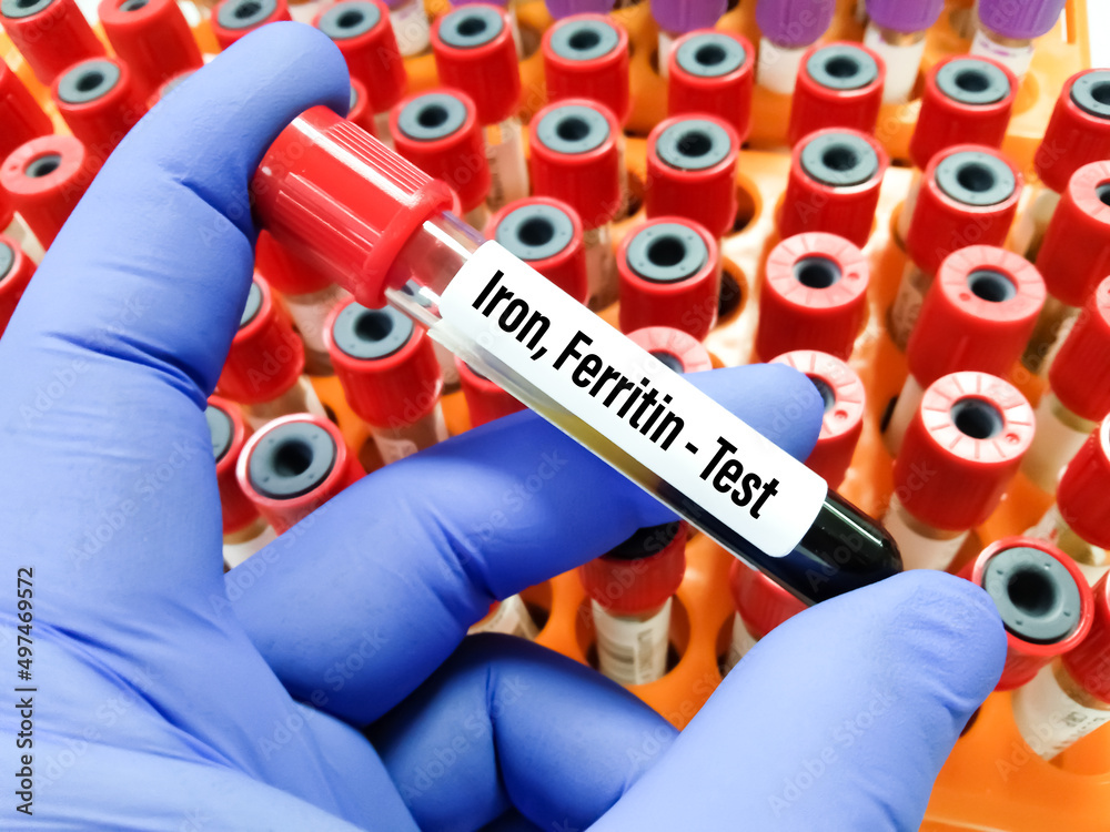 Blood sample for Iron, TIBC and Ferritin level test. To diagnosis Iron ...