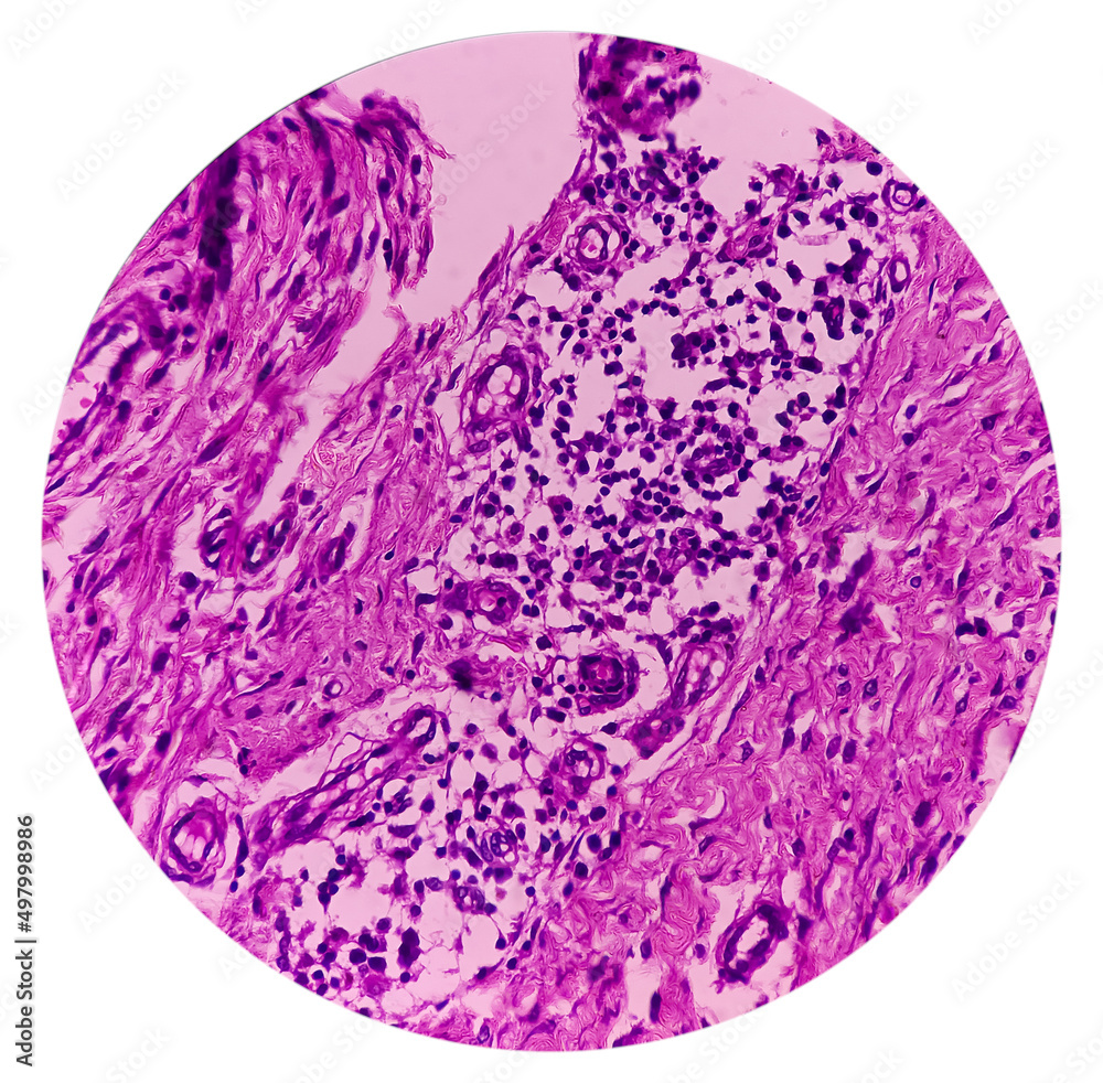Infected wound tissue: Foreign body granuloma, skin, subepithelial ...