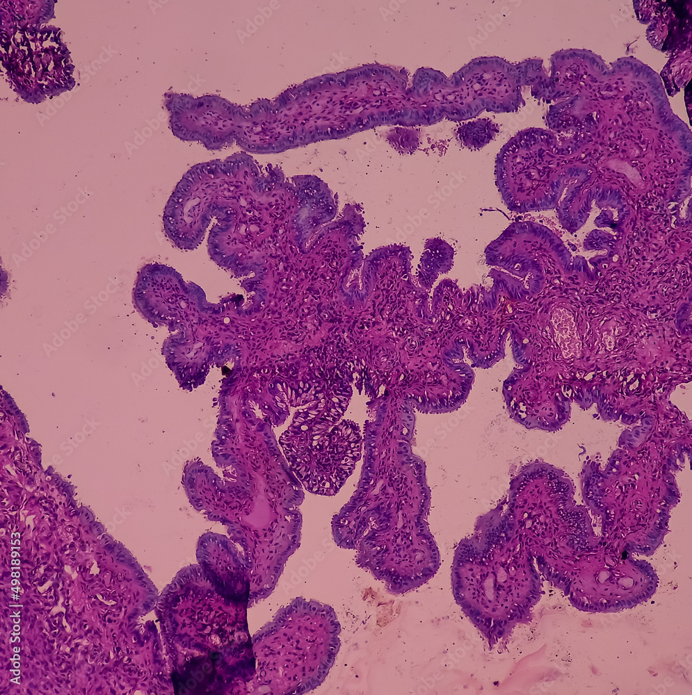 Fimbrial cyst(biopsy): show fallopian tube, features of fimbrial cyst ...