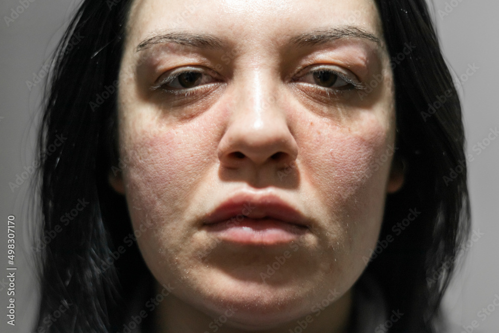Caucasian woman with allergic reaction. Problematic face skin. Symptoms ...