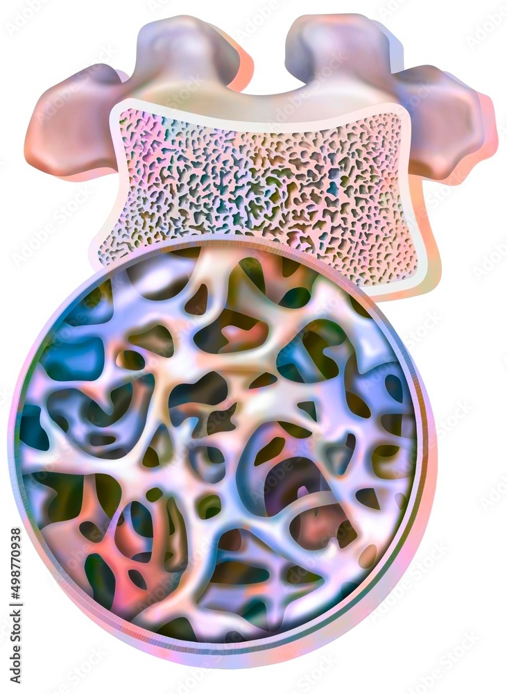 Structure of a healthy dorsal vertebra with spongy and compact tissue ...