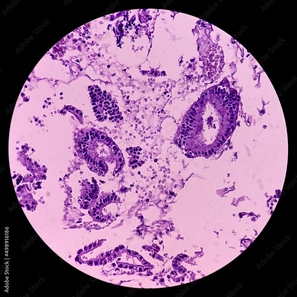 Endocervical tissue biopsy: Photomicrograph show part of ectocervix and ...