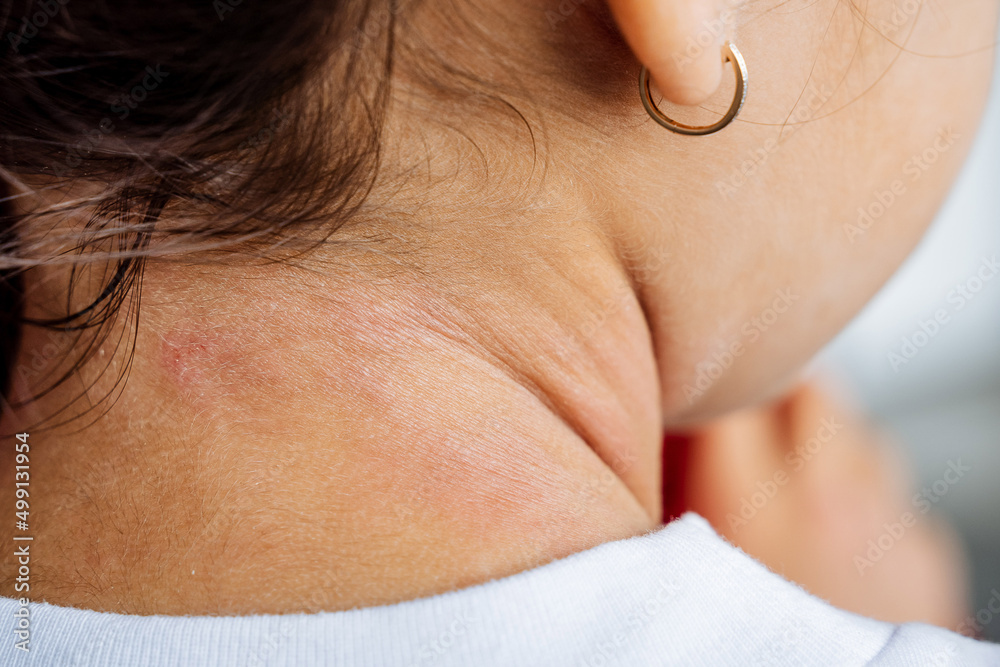 Foto de Stock Dry skin on the neck, dermatitis of the skin, the disease ...