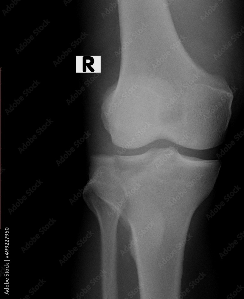 Tibial plateau fractures are break in the upper part of the shinbone ...