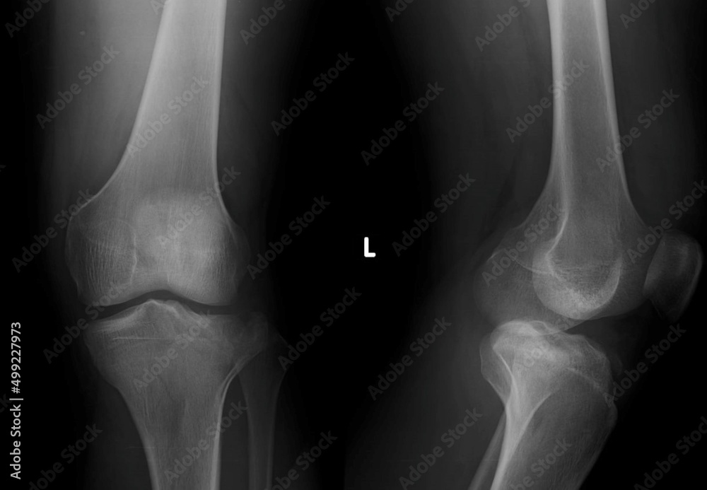 Tibial plateau fractures are break in the upper part of the shinbone ...