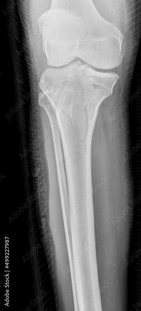 Tibial plateau fractures are break in the upper part of the shinbone ...