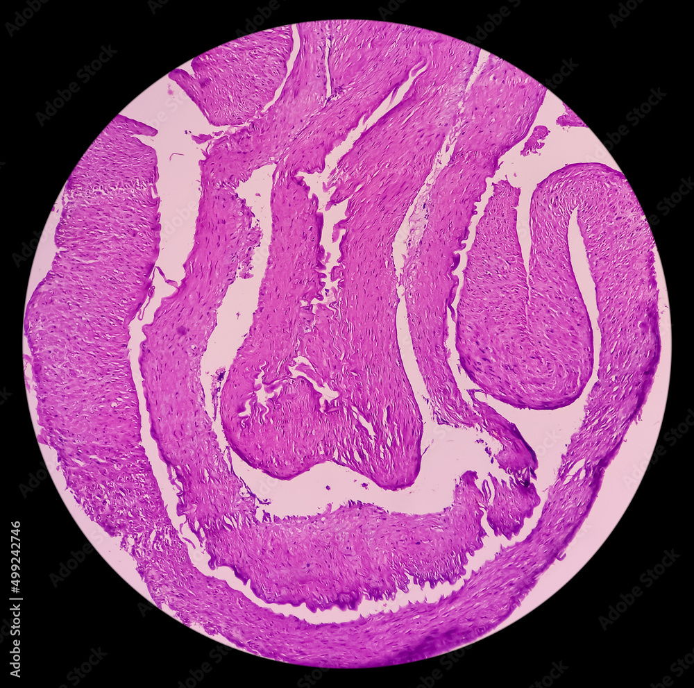Kidney(biopsy): Chronic pyelonephritis, show areas of thyroidization ...