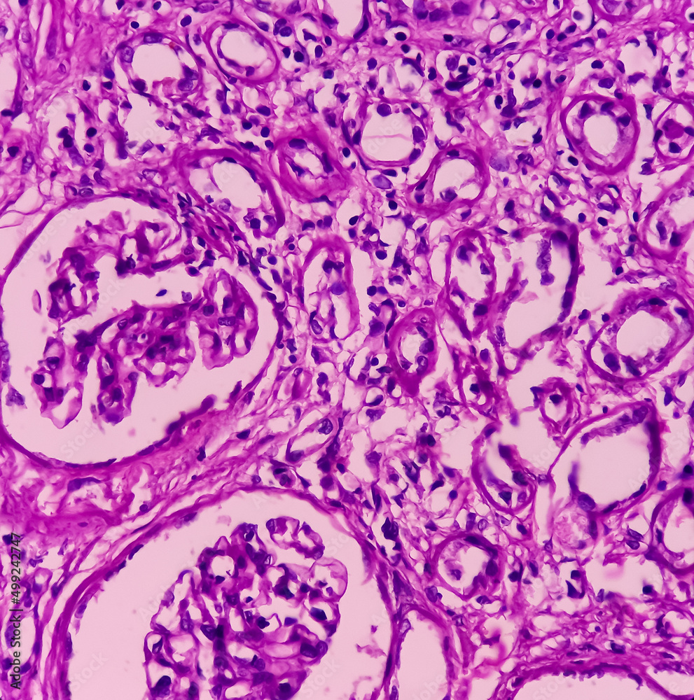 Kidney(biopsy): Chronic pyelonephritis, show areas of thyroidization ...