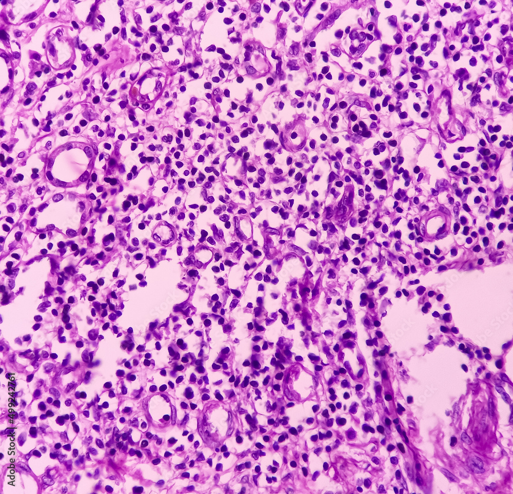 Kidney(biopsy): Chronic pyelonephritis, show areas of thyroidization ...