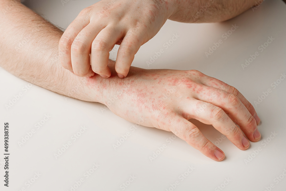 Male hands scratching itchy red spots on skin. Allergy reaction from ...