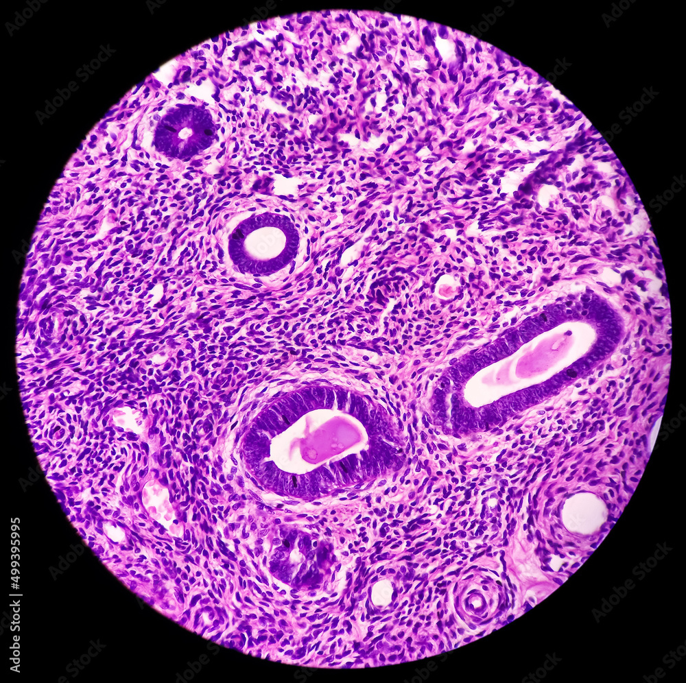 Cervix: Chronic cervicitis with prolapse, cervix show chronic ...